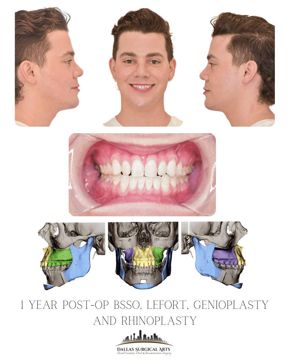 Jaw Repositioning (Orthognathic Surgery) | Dallas Surgical Arts